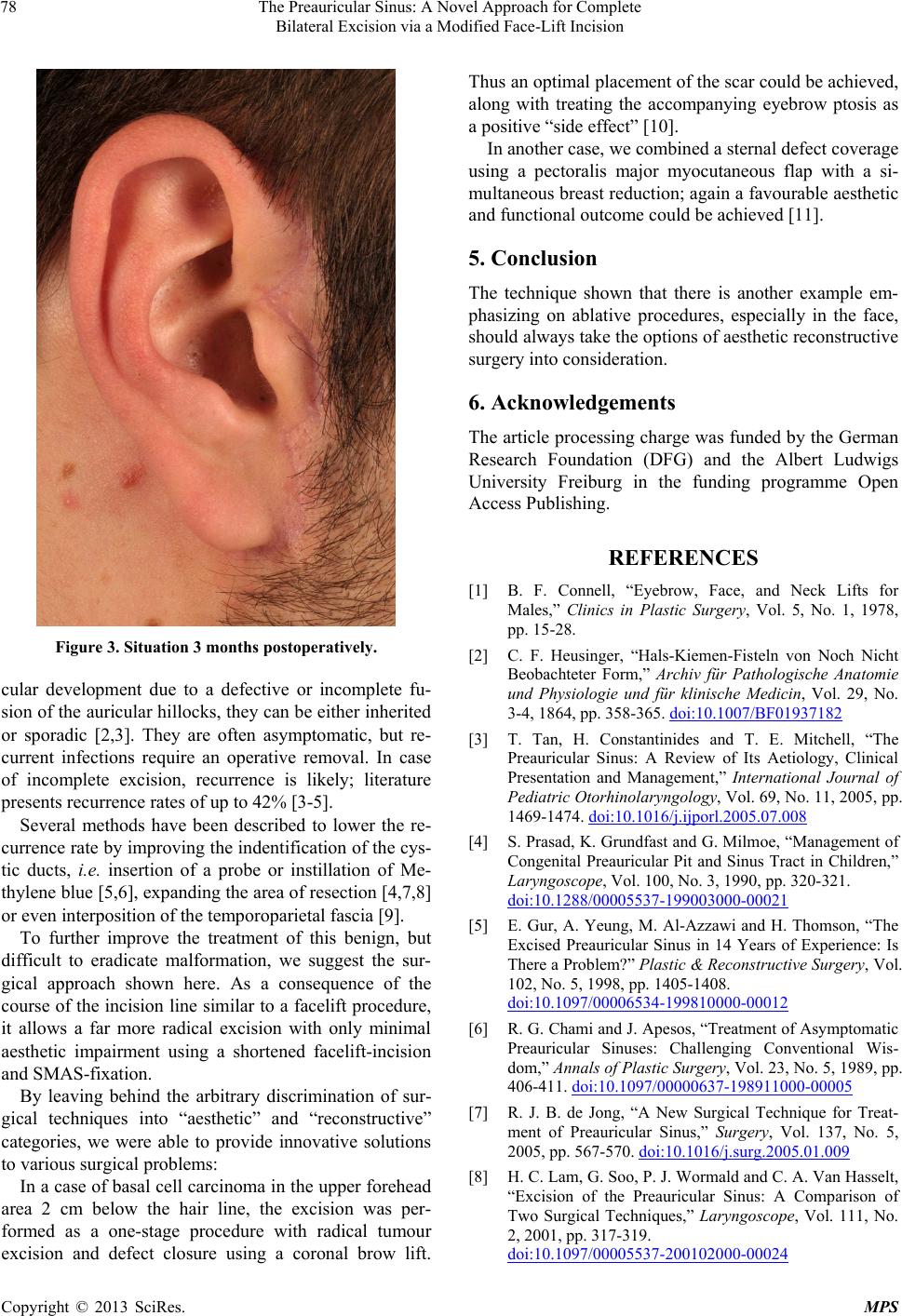 The Preauricular Sinus: A Novel Approach for Complete Bilateral ...