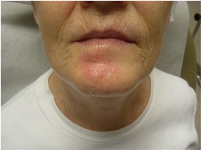 Reconstruction of Chin Defects Using an O to Z Bilateral Rotation Flap