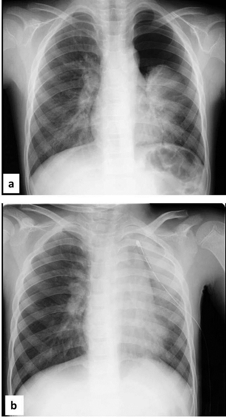 Re-expansion pulmonary edema in a boy with spontaneous pneumothorax ...