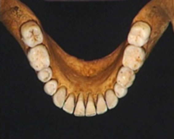 Occlusal tooth wear in human sculls of antique period from Vendenis and ...
