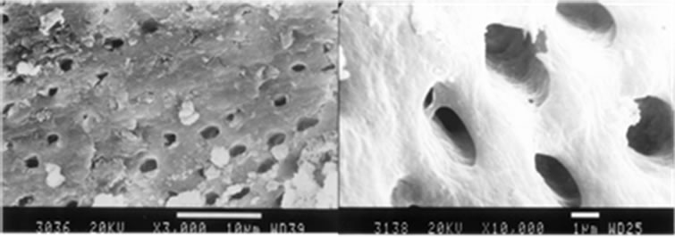 The cleaning efficiency of the root canal after different ...