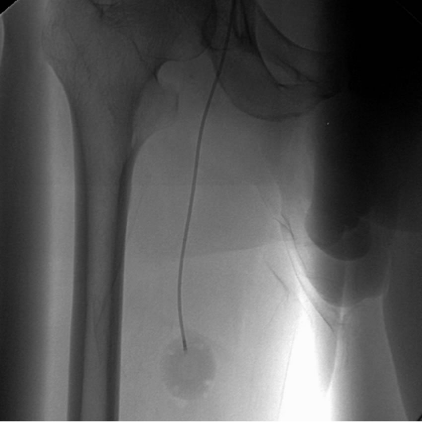 Implantable Venous Access Ports for Chemotherapy in Lung Cancer ...