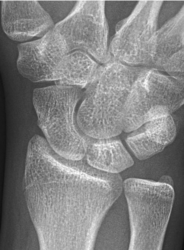 Carpal Coalitions; Failures of Differentiation of the Carpus: A ...