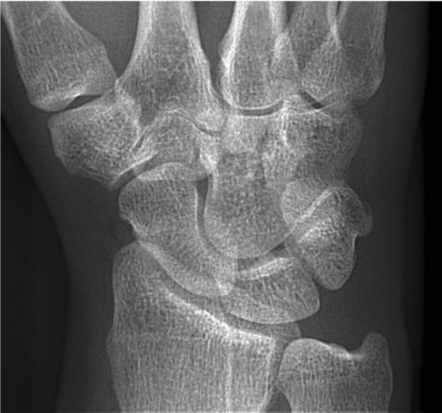 Carpal Coalitions; Failures of Differentiation of the Carpus: A ...