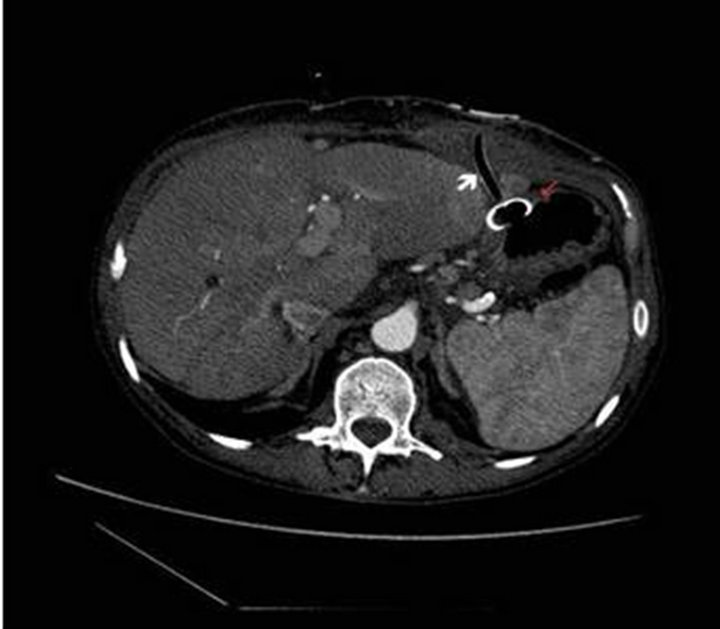 Transhepatic percutaneous endoscopic gastrostomy