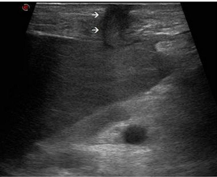Transhepatic percutaneous endoscopic gastrostomy