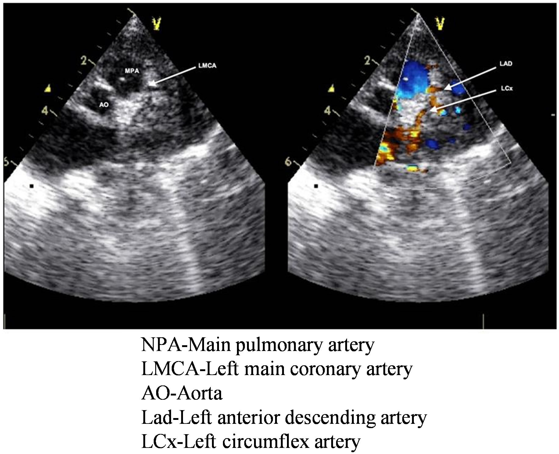 Three Cases of ALCAPA with Associated Anomalies