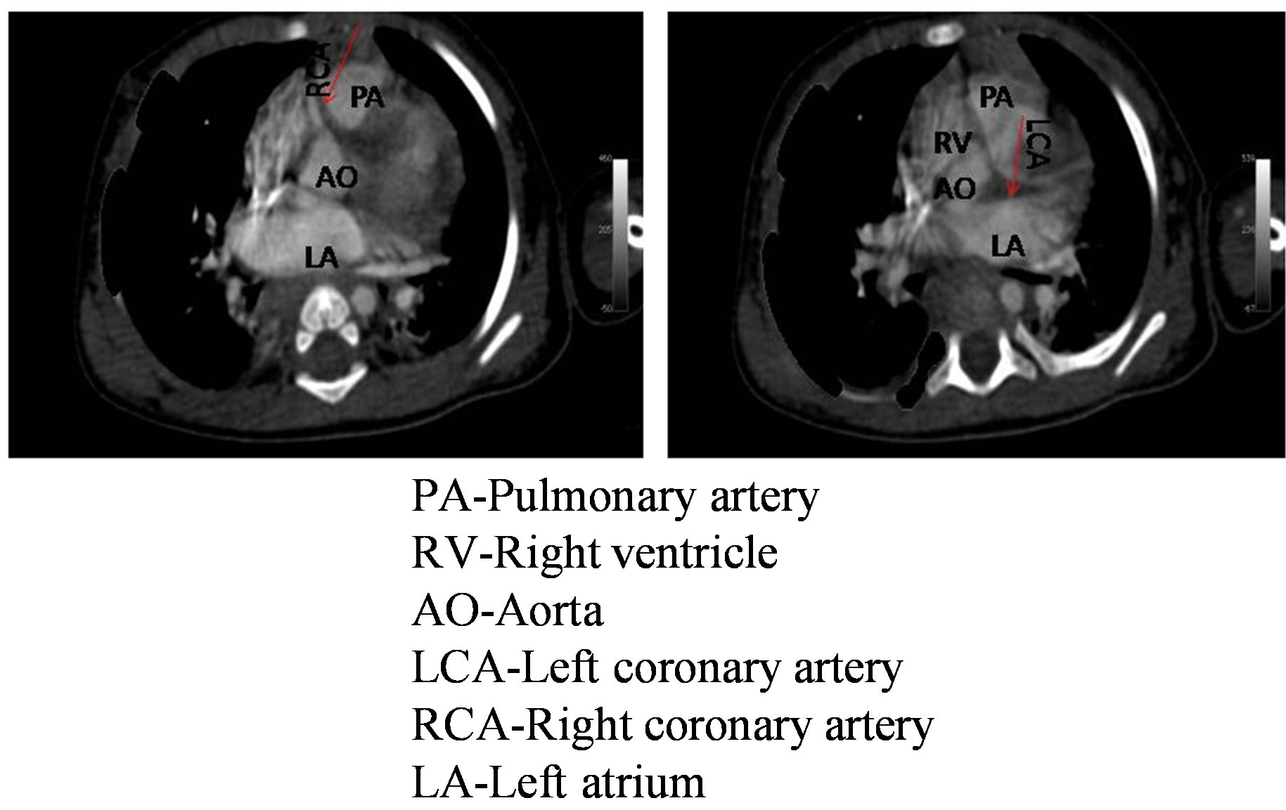 Three Cases of ALCAPA with Associated Anomalies