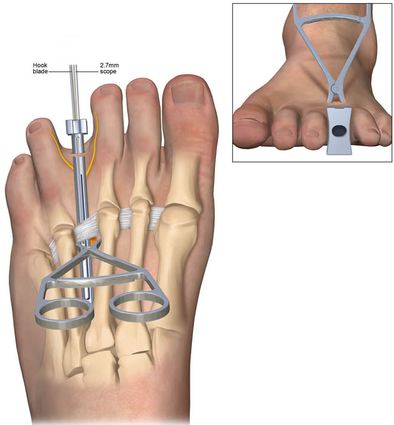 Endocsopic Decompression of Intermetatarsal Nerve (EDIN) for the ...