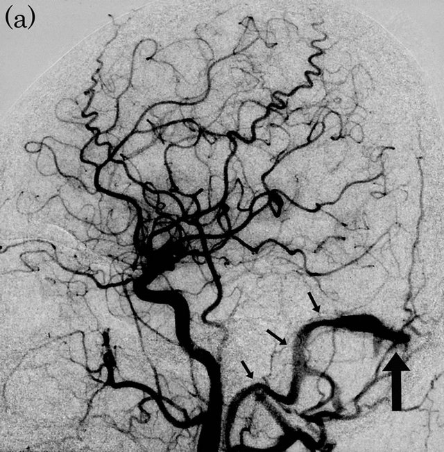 Intracranial Dural Arteriovenous Fistula: Preliminary Report of ...