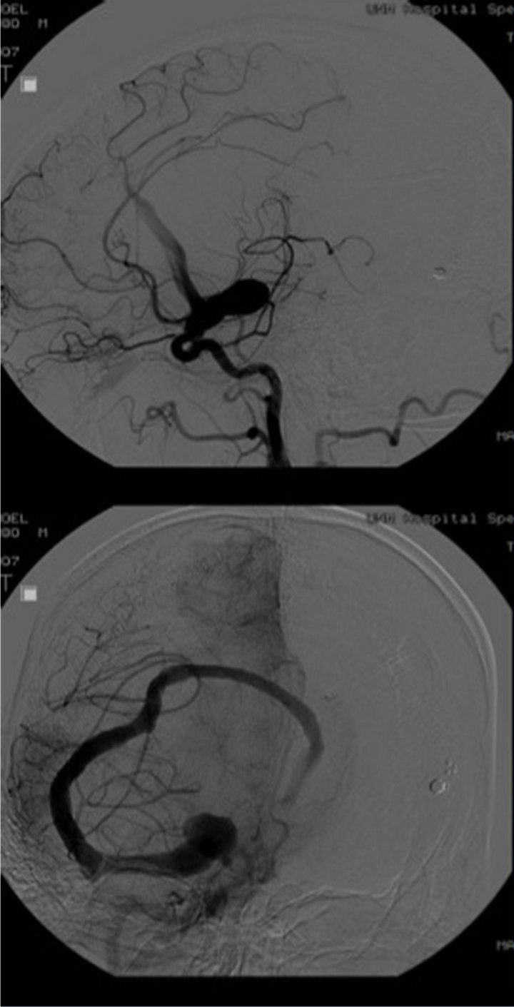 Giant Serpentine Aneurysm Treated with Double EC-IC Bypass with ...