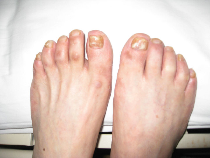 Possible Metformin-Induced Toe Nails Disorder