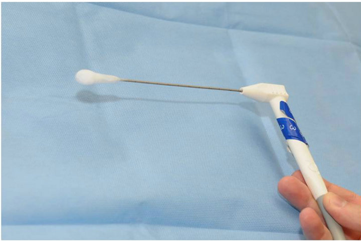 Anesthesia Management for Pulmonary Cryoablation