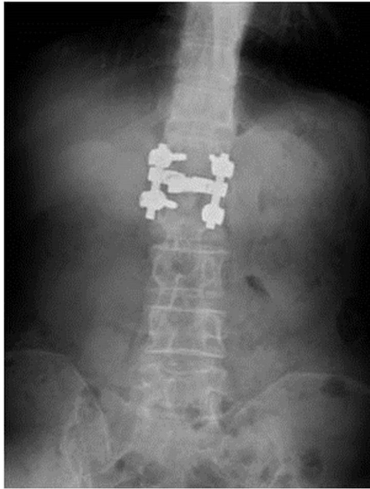 Lumbar Disc Herniation with End-Plate Fracture and Secondary ...