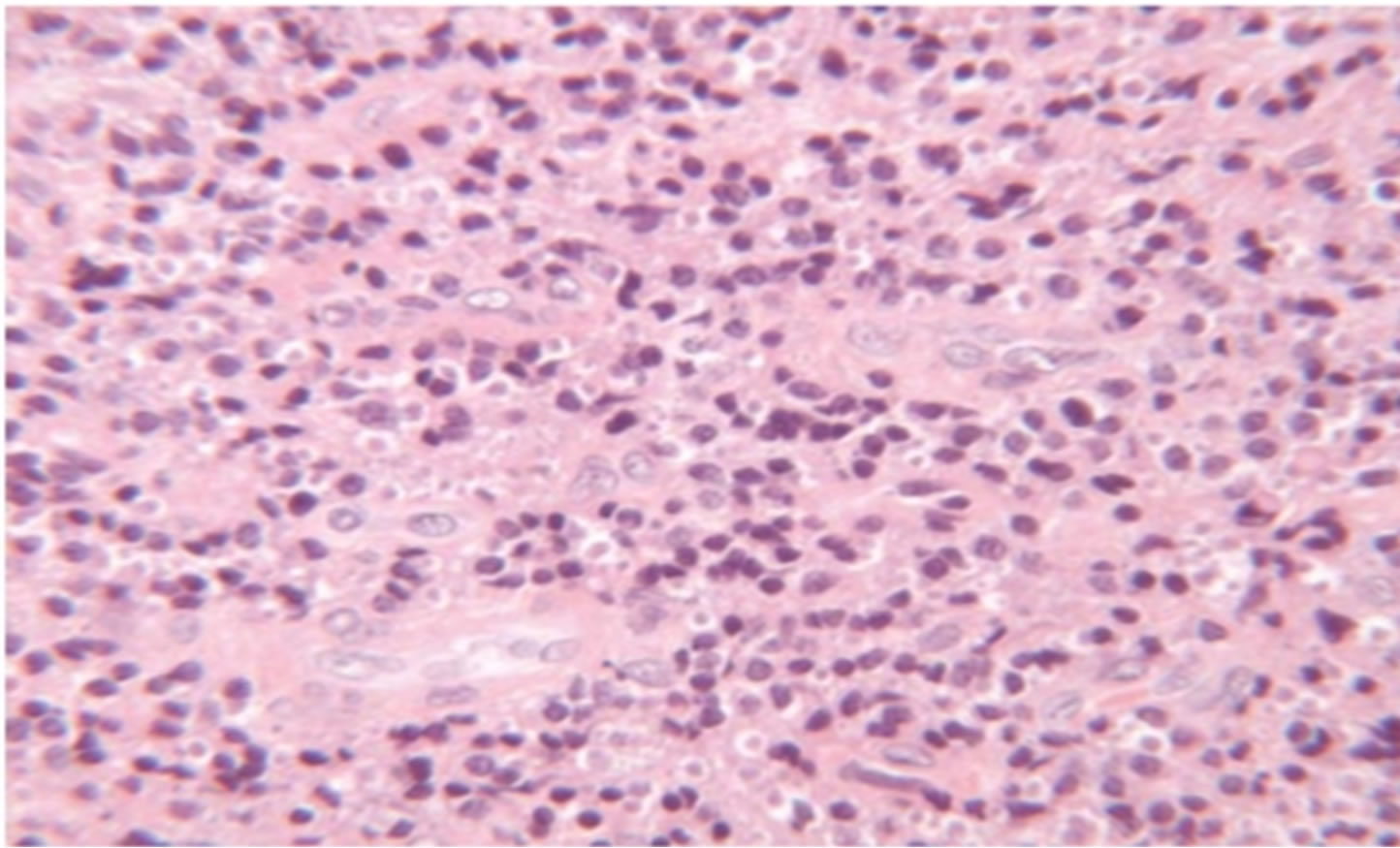 Palatal Cyst: An Unusual Case Report