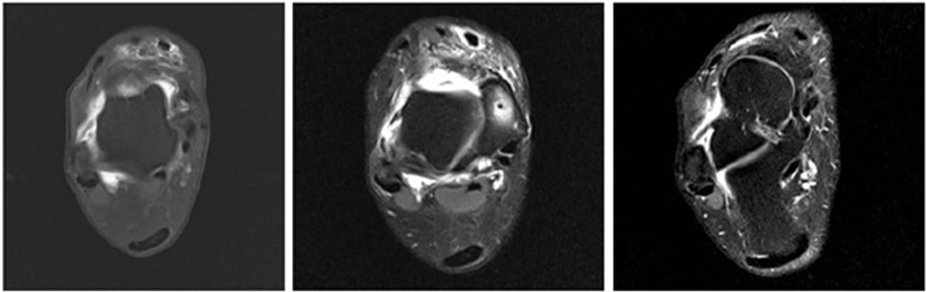 Pseudoband formation: Missed ATFL tears on MR imaging
