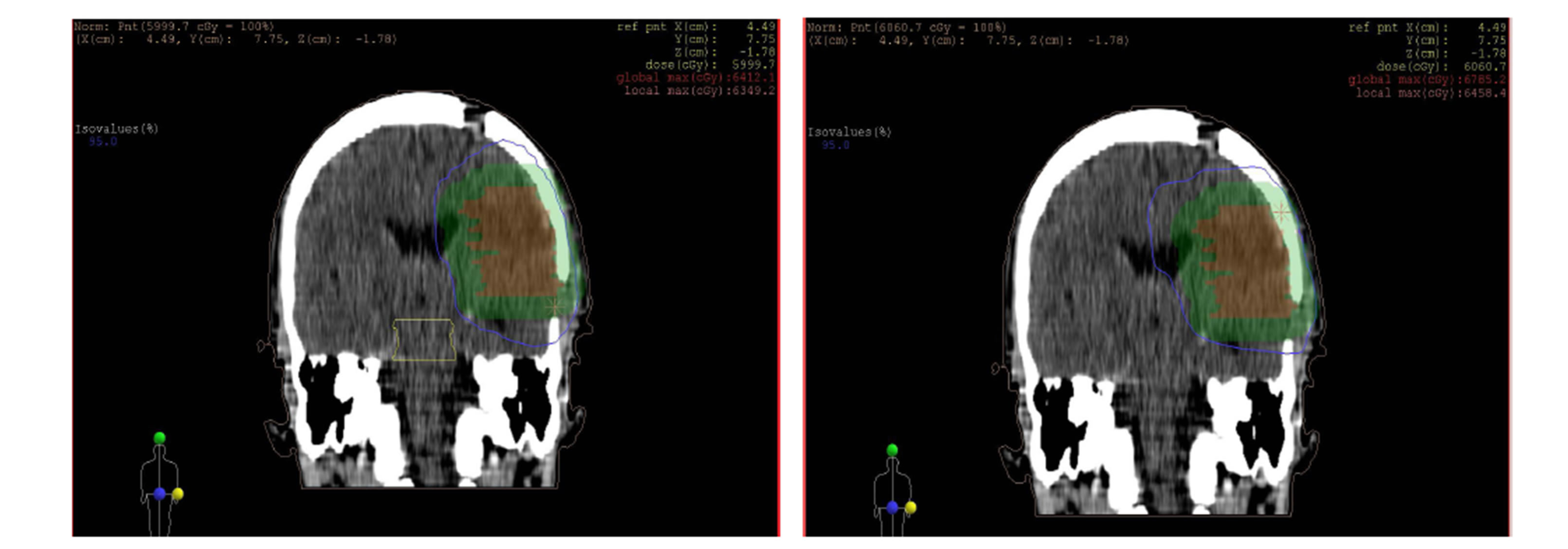 Dosimetric Comparison of Intensity-Modulated Radiotherapy versus Three ...