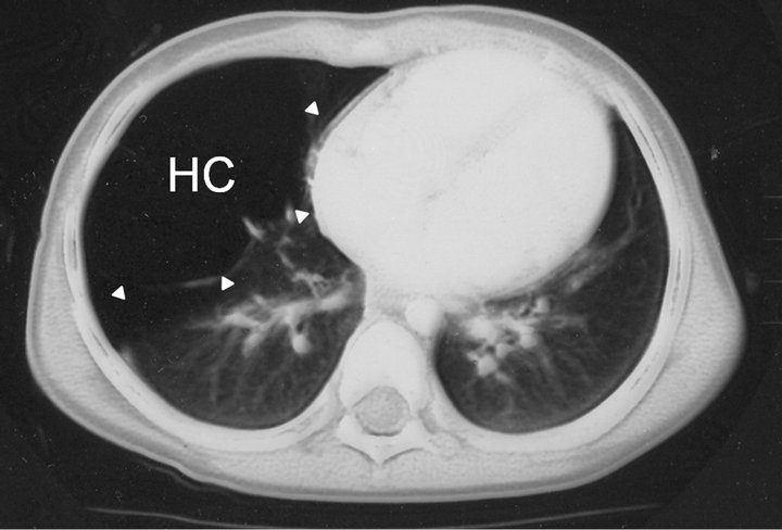 Treatment of a densely fused fissure during thoracoscopic right middle ...