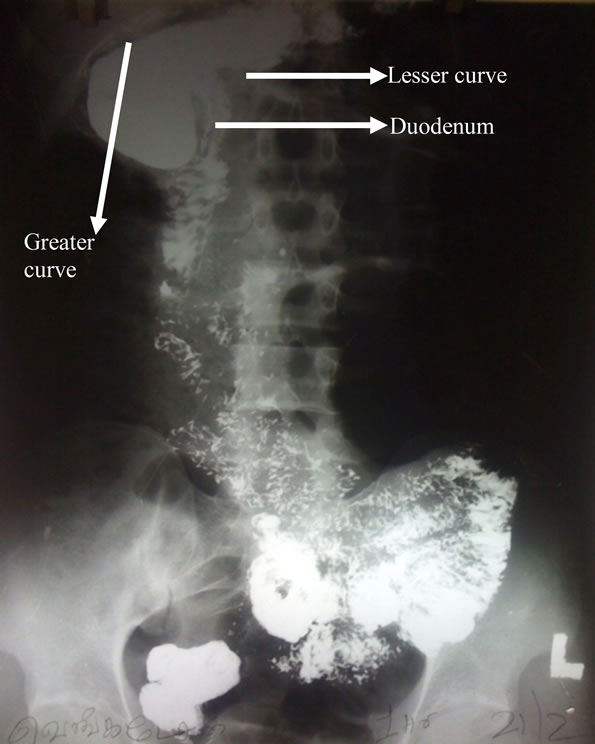 Interesting and unusual cases of chronic abdominal pain-intermittent ...