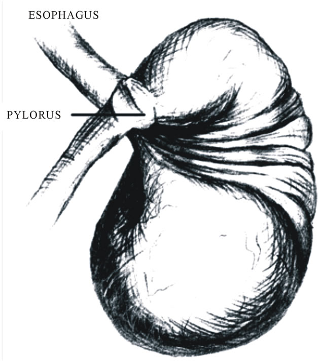 Interesting and unusual cases of chronic abdominal pain-intermittent ...