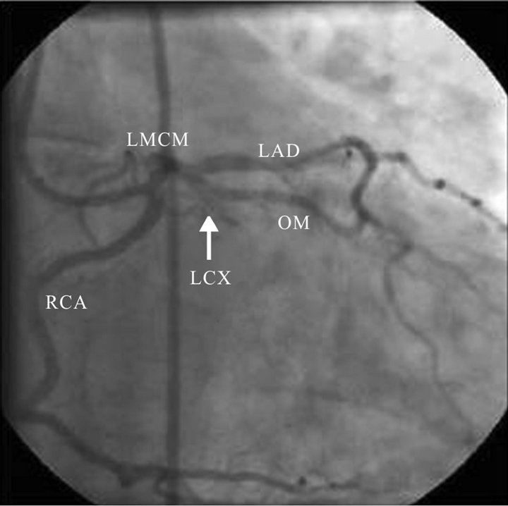 Coronary angioplasty for in-stent restenosis in patient with anomalous single coronary artery ...