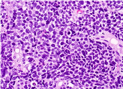 Prostatic Small Cell Carcinoma: Diagnosis and Management