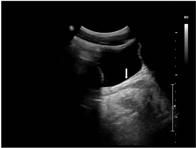 Primary amenorrhea with transverse vaginal septum and scant ...