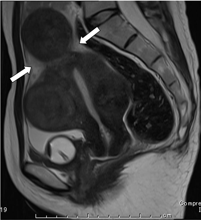 Successful laparoscopic management of hemoperitoneum due to spontaneous ...