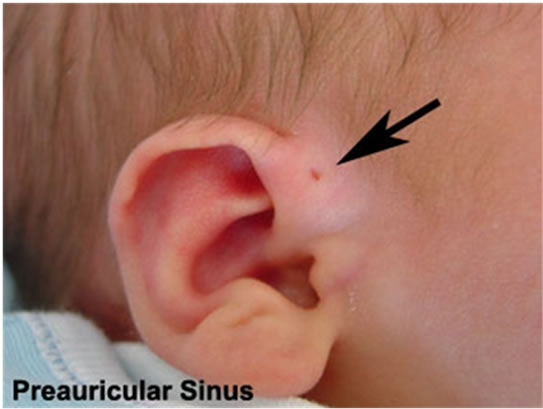 Neonatal pre-auricular pits/sinuses: Survey of management strategies by ...