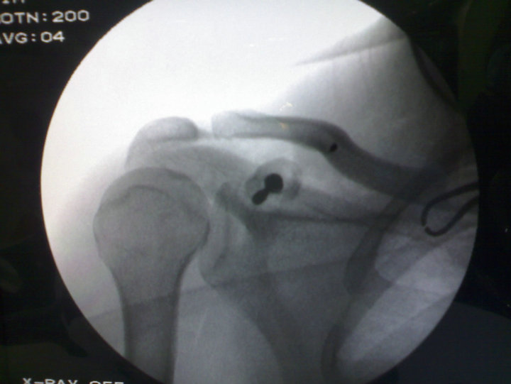 Coracoid Process Fracture: A Report of Two Cases and Brief Review of ...