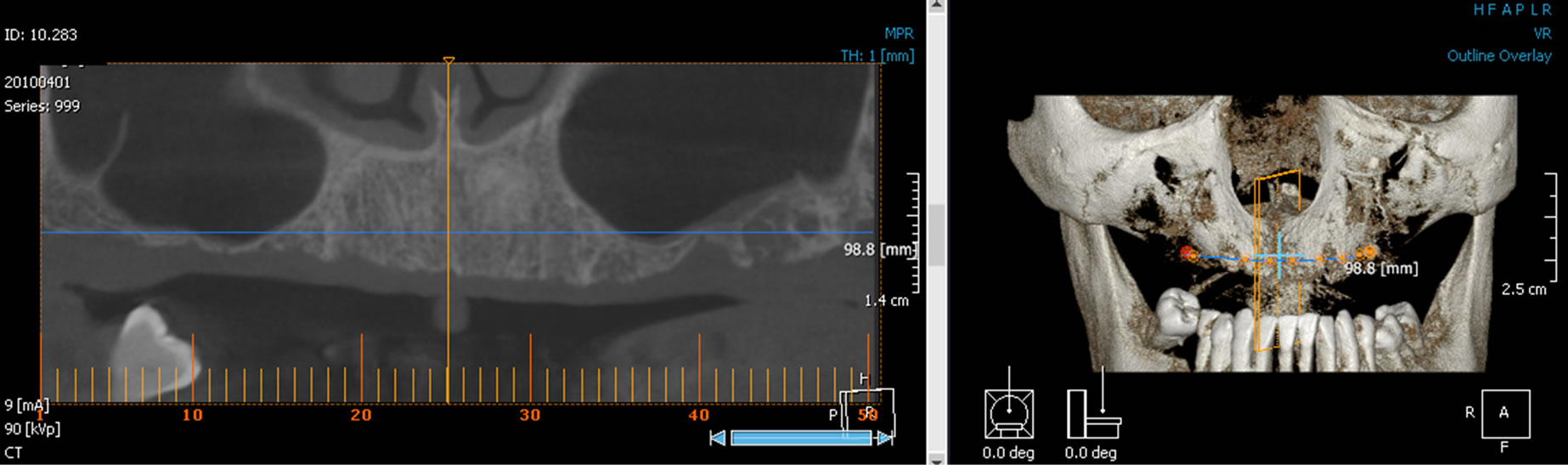 A simple method for repairing membrane sinus perforation