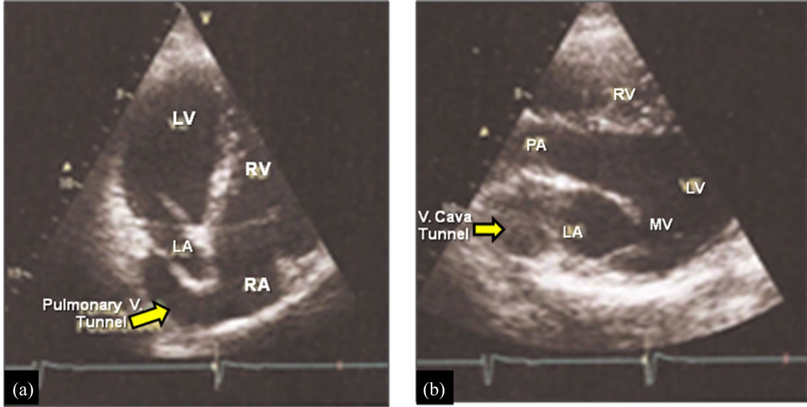 Senning operation for correction of the transposition of the great ...