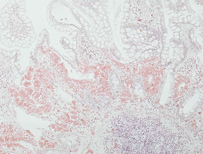 Clinical management of gastrointestinal amyloidosis
