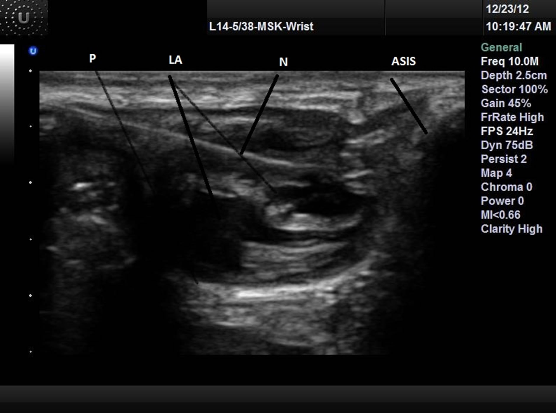 Ilioinguinal Nerve Block Ultrasound