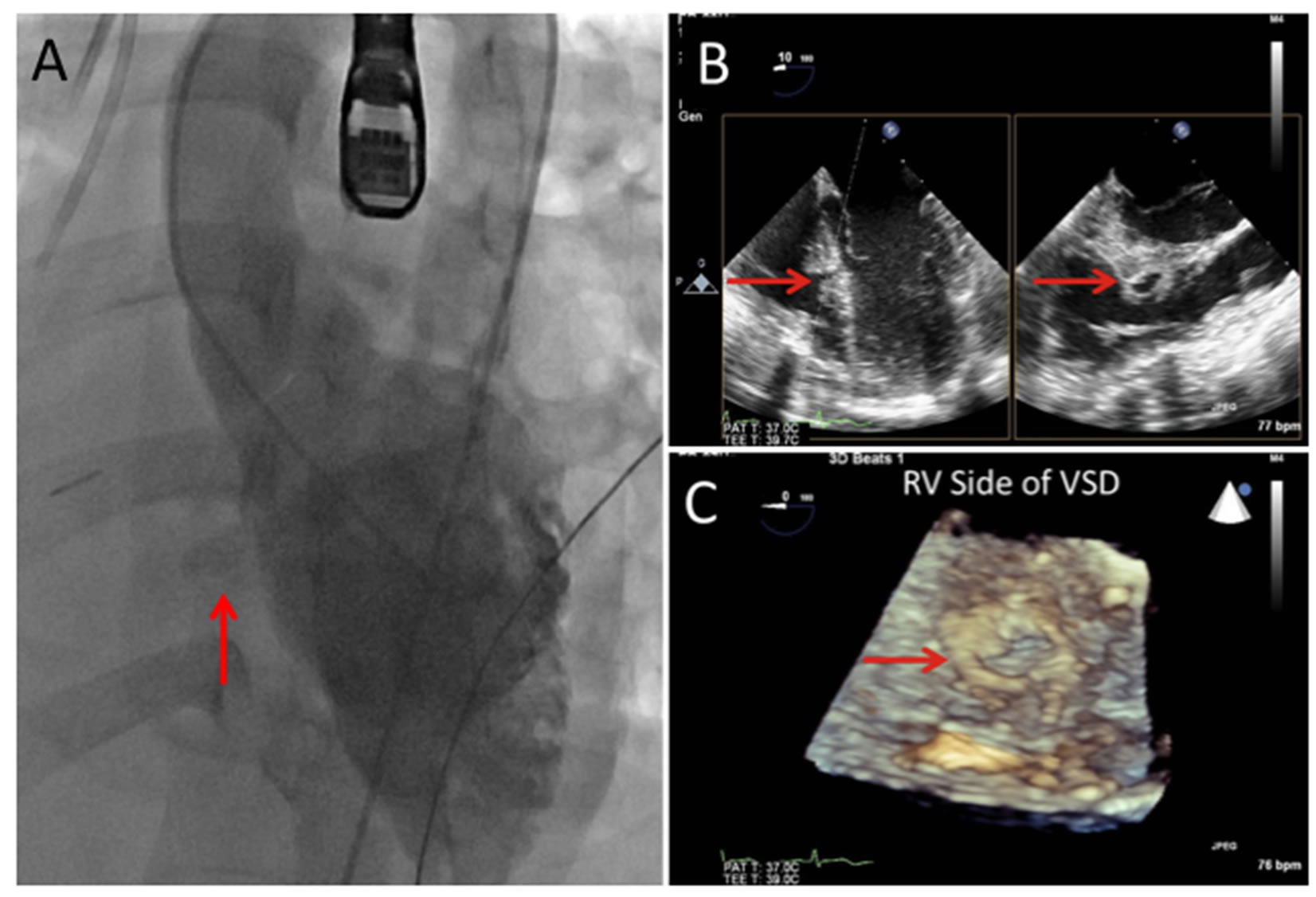 Multi-Modality Imaging in a Hybrid Setting Facilitates Transcatheter ...