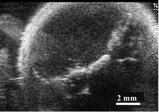 Cloverleaf Skull Ultrasound