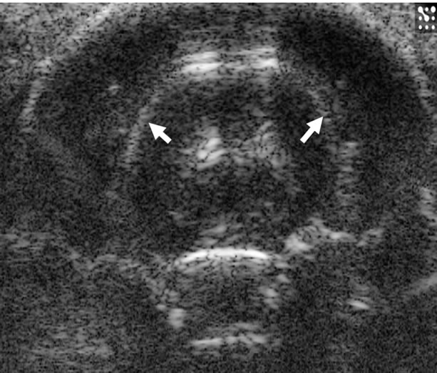 High-Resolution Ultrasound in Research of Mouse Orthotopic Glioma and ...