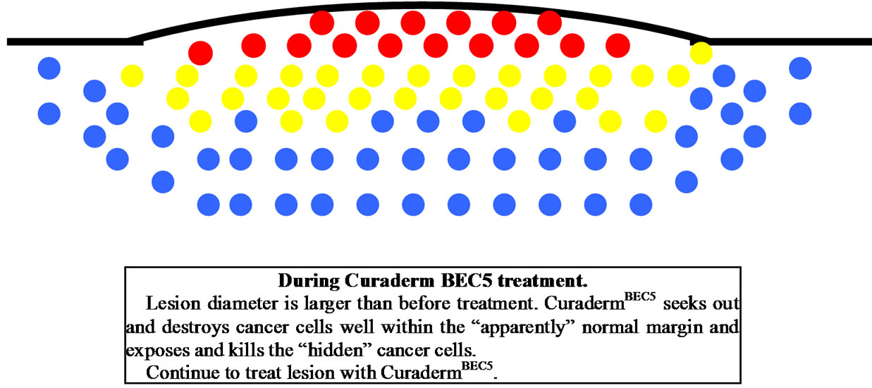 Curaderm BEC5 for Skin Cancers, Is It? An Overview