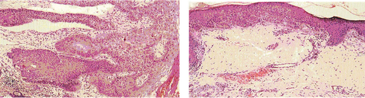 Curaderm BEC5 for Skin Cancers, Is It? An Overview