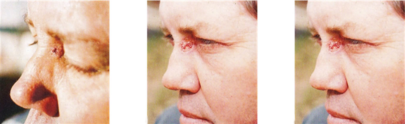 Curaderm BEC5 for Skin Cancers, Is It? An Overview