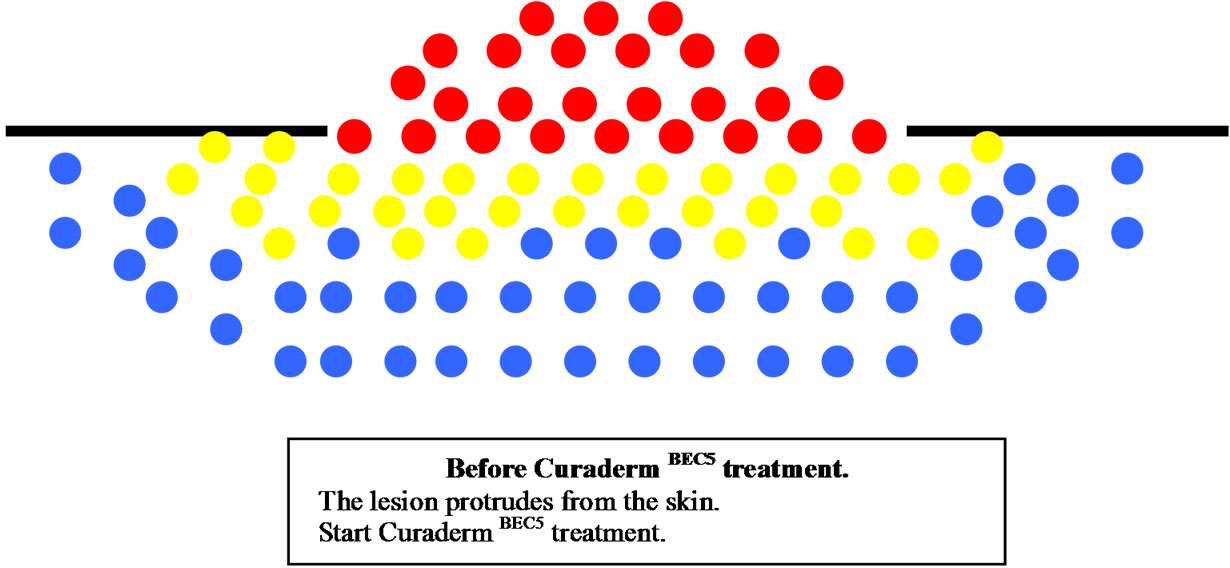 Curaderm BEC5 for Skin Cancers, Is It? An Overview