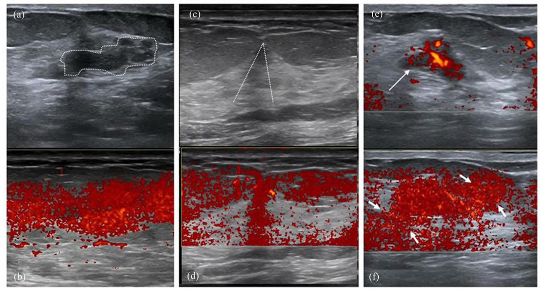Power Doppler Vocal Fremitus Breast Sonography: Differential Diagnosis ...