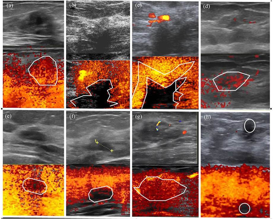 Power Doppler Vocal Fremitus Breast Sonography: Differential Diagnosis ...