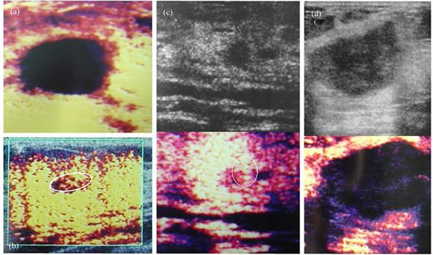 Power Doppler Vocal Fremitus Breast Sonography: Differential Diagnosis ...
