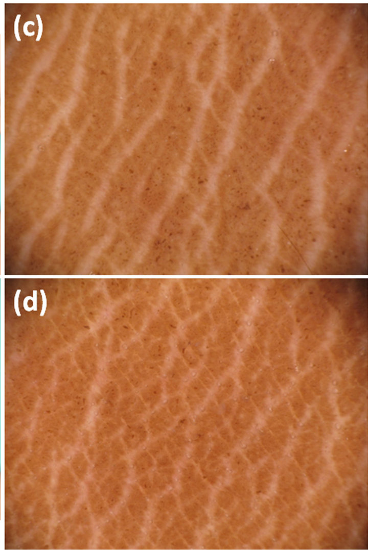 Dermoscopic Features of Hyperpigmented Dots in Crista Cutis in Two ...