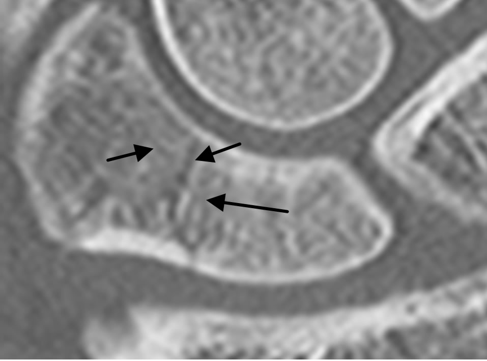 Efficacy of high resolution computed tomography for detection of early ...