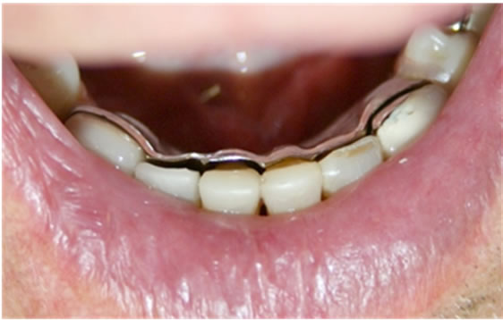 Clinical performance of removable partial dentures: A retrospective ...