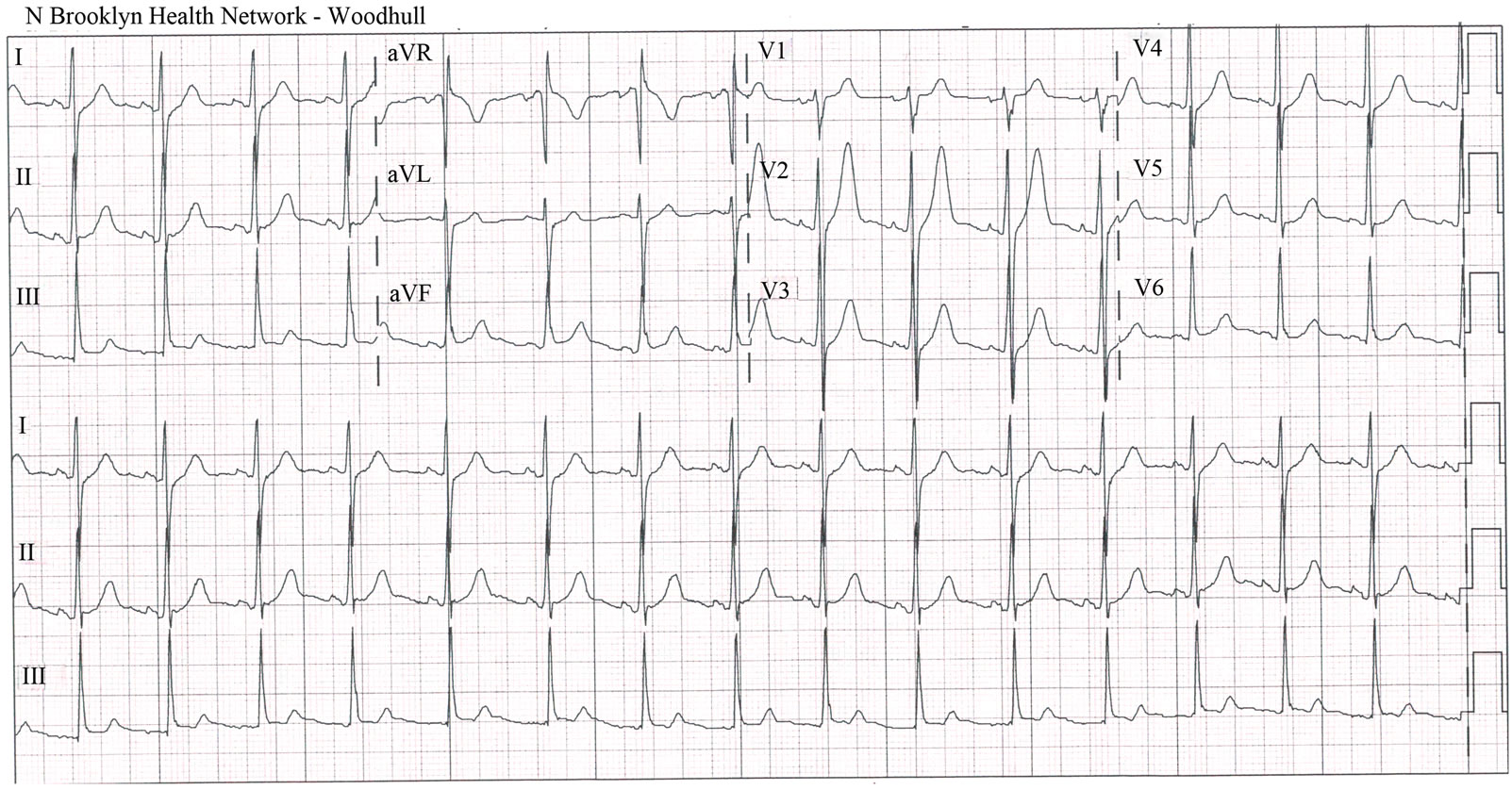 Electrocardiogram manifestations in hyperkalemia