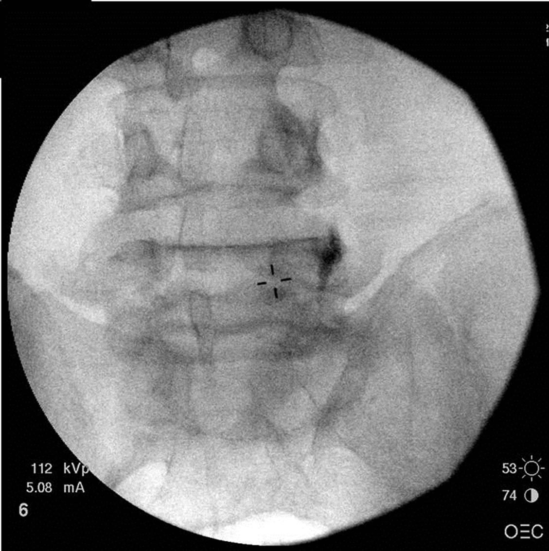 Case Series of Methylene Blue Injections for the Treatment of ...