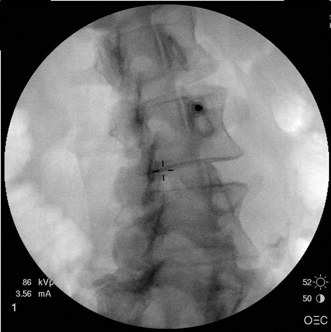 Case Series of Methylene Blue Injections for the Treatment of ...
